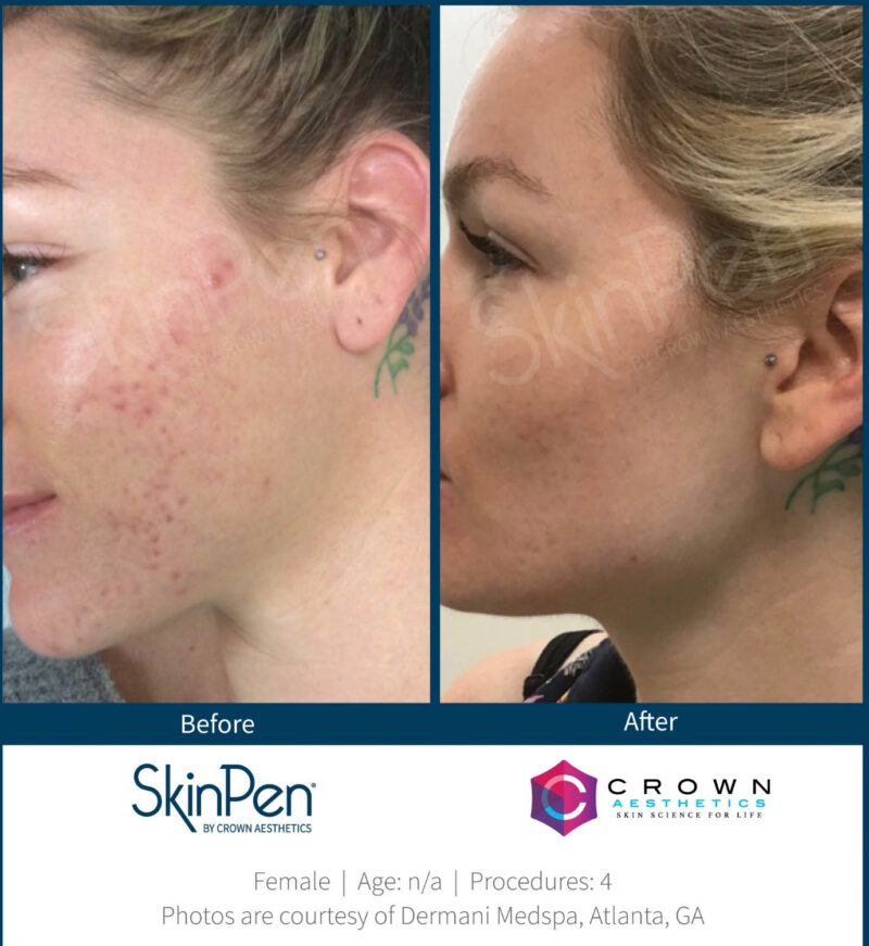 SkinPen Kidderminster | Foley Park Dental & Implant Centre