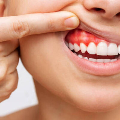 How to fix bleeding gums | Foley Park Dental & Implant Centre